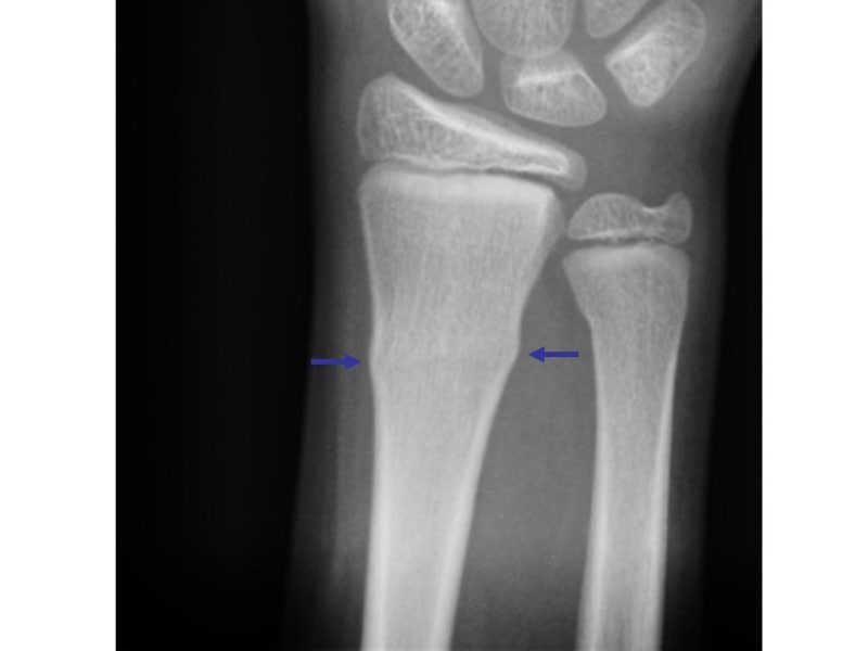 융기골절 (Torus fracture, Buckle fracture) : 네이버 블로그
