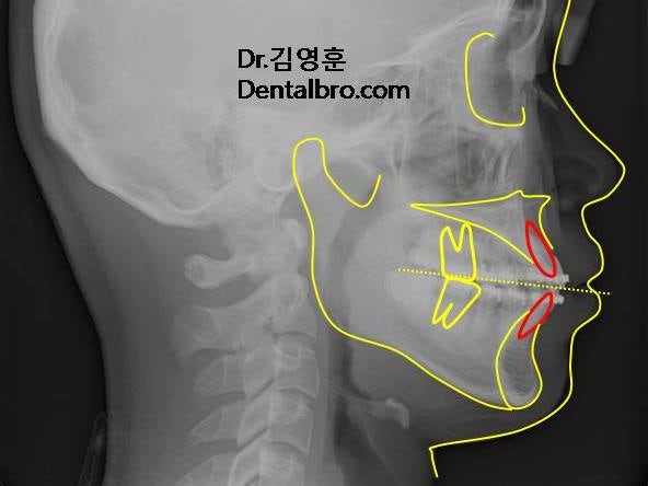 MEAW 1(multi loop edgewise archwire) : 네이버 블로그