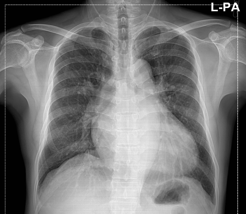 심방, 심실 확장, 흉부 엑스레이, Atrium, ventricle, enlargement, chest PA : 네이버 블로그