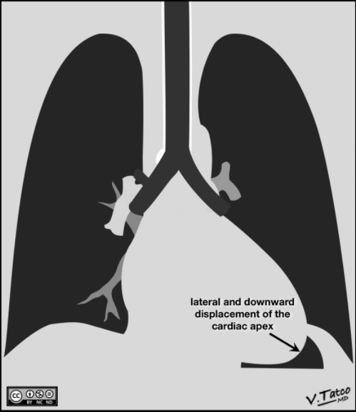 심방, 심실 확장, 흉부 엑스레이, Atrium, ventricle, enlargement, chest PA : 네이버 블로그