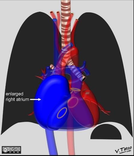 심방, 심실 확장, 흉부 엑스레이, Atrium, ventricle, enlargement, chest PA : 네이버 블로그