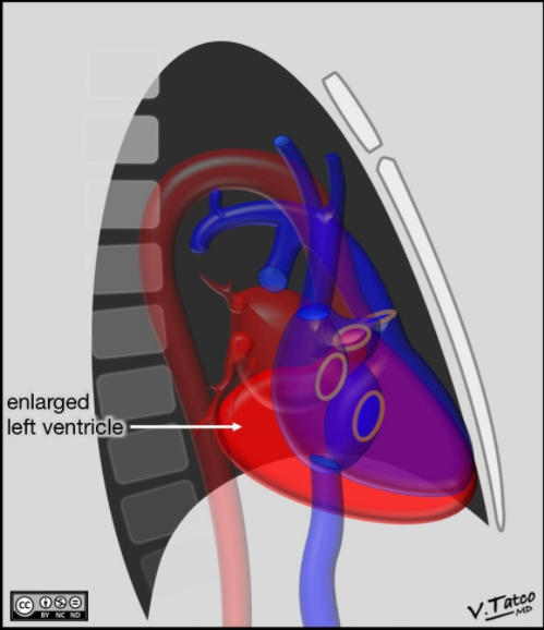 심방, 심실 확장, 흉부 엑스레이, Atrium, ventricle, enlargement, chest PA : 네이버 블로그