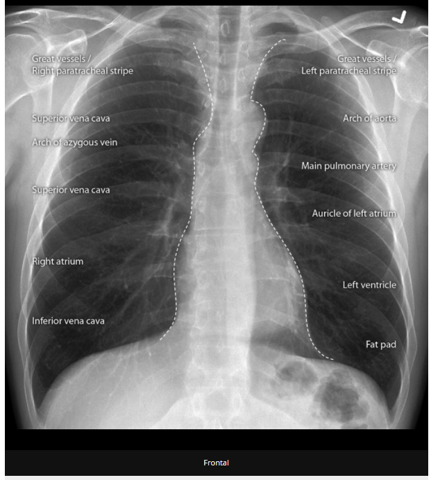 심방, 심실 확장, 흉부 엑스레이, Atrium, ventricle, enlargement, chest PA : 네이버 블로그