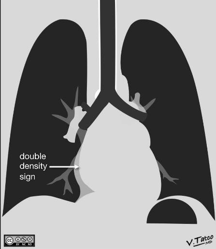 심방, 심실 확장, 흉부 엑스레이, Atrium, ventricle, enlargement, chest PA : 네이버 블로그