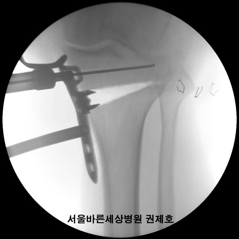 근위경골절골술 퇴행성관절염으로부터 자기 관절 지키는 방법 네이버 블로그
