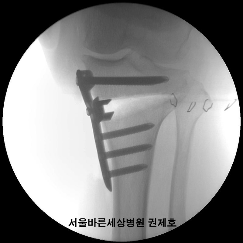 근위경골절골술 퇴행성관절염으로부터 자기 관절 지키는 방법 네이버 블로그