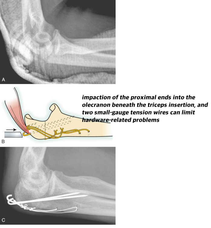 ORIF, Olecranon fracture : 네이버 블로그