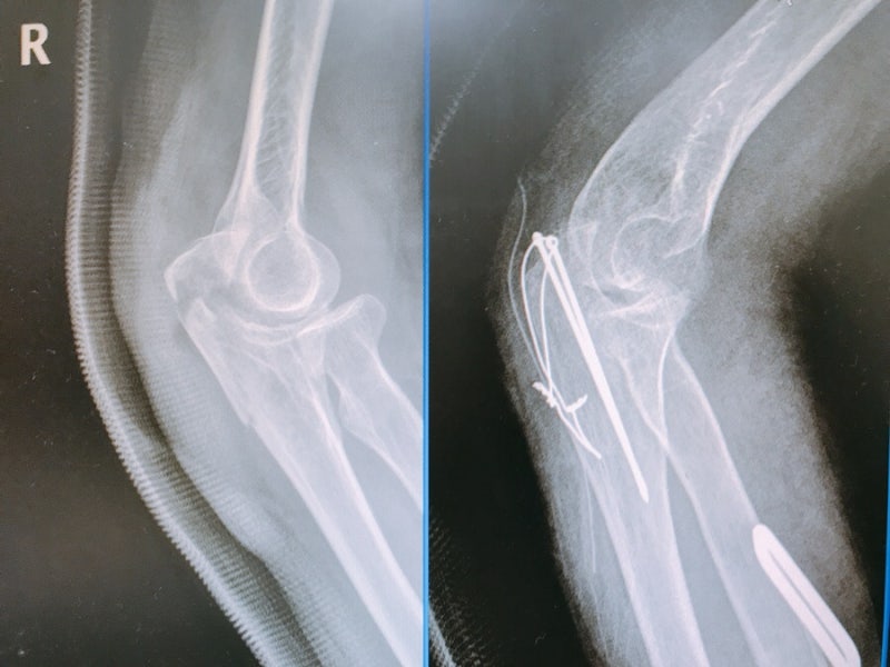 ORIF, Olecranon fracture : 네이버 블로그