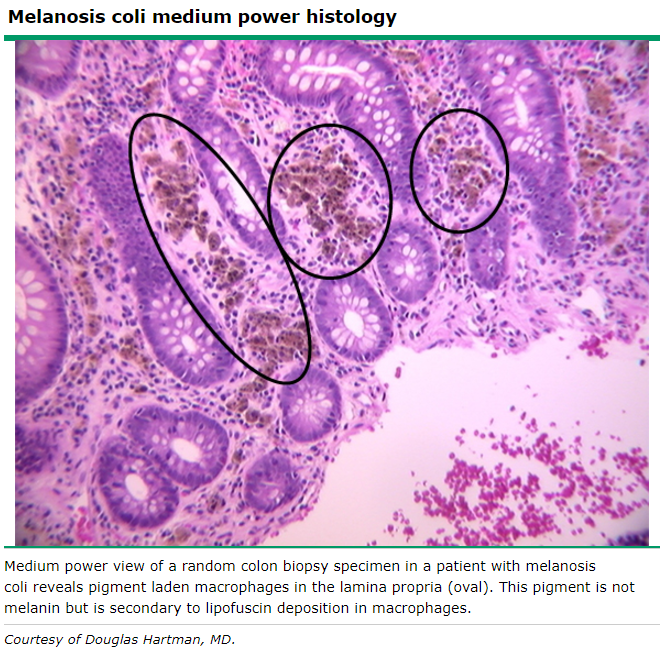 대장 흑색증, Melanosis coli (4) : 네이버 블로그