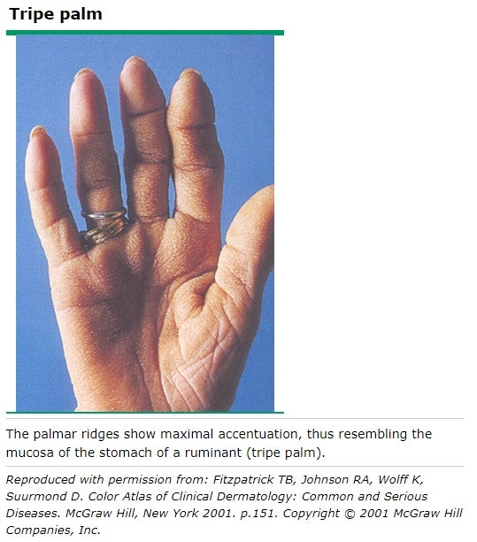 Malignancy-associated acanthosis nigricans : 네이버 블로그