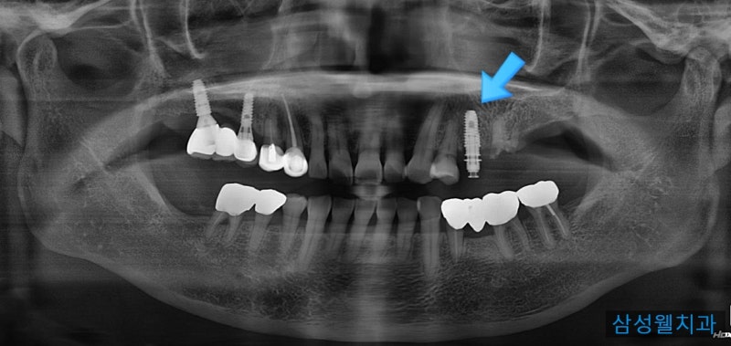 이를 뽑자마자 임플란트 심기 (발치후 즉시 식립 - 발즉) : 네이버 블로그