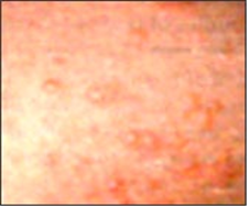 지아노티-크로스티 증후군과 피부발진 Gianotti-Crosti syndrome and skin rash : 네이버 블로그