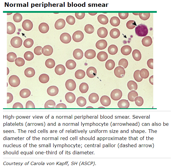 Hereditary spherocytosis: Mechanism of hemolysis and pathogenesis (1 ...