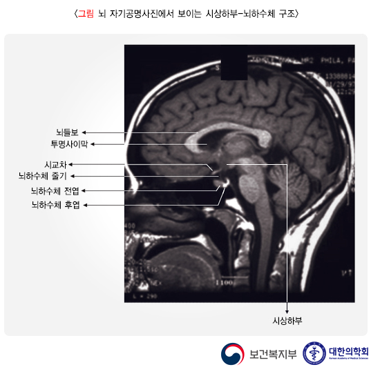 뇌하수체 양성신생물 원인과 증상알고 치료하기 네이버 블로그