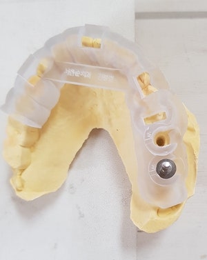 서울순치과 이호정 원가이드를 이용한 상악동 거상술 (ONE CAS KIT출시이전의 방법) : 네이버 블로그