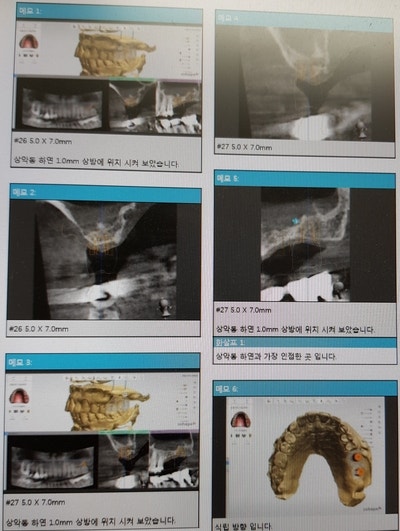 서울순치과 이호정 원가이드를 이용한 상악동 거상술 (ONE CAS KIT출시이전의 방법) : 네이버 블로그