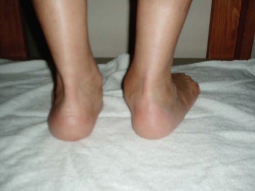 후경골근건염 / 후경골근기능부전 : 네이버 블로그