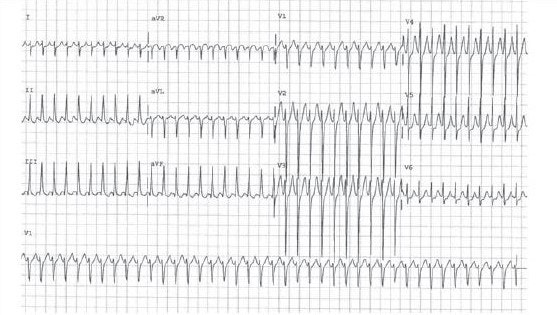 WPW syndrome : 네이버 블로그