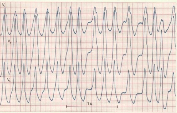 WPW syndrome : 네이버 블로그