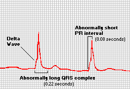 WPW syndrome : 네이버 블로그