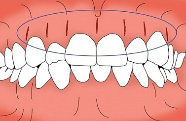 급속교정방법 : 코티시전(Corticision) : 네이버 블로그
