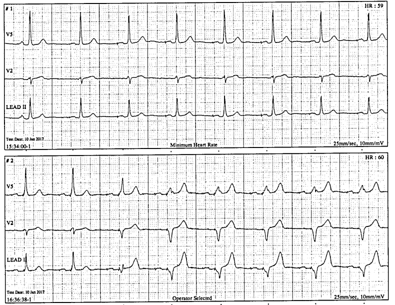 DDD pacemaker ECG : 네이버 블로그