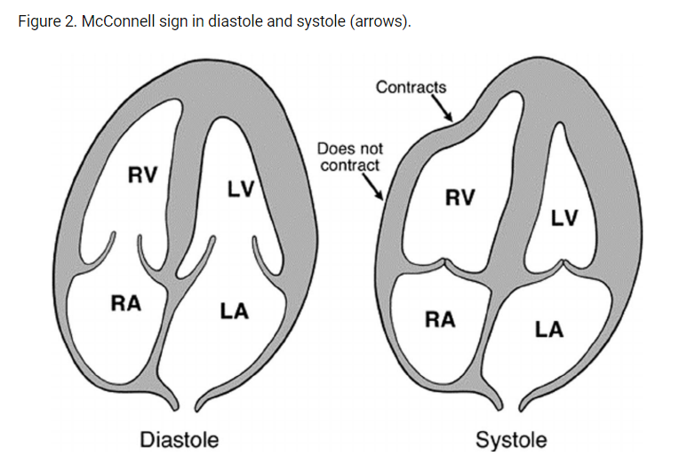 폐동맥색전증, 심장초음파, PTE, echocardiography : 네이버 블로그