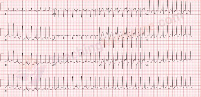 Atrial Fibrillation With Rvr