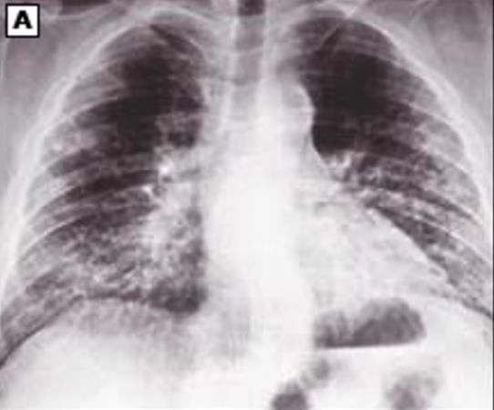 PCP 방사선 소견, PCP radiographic findings : 네이버 블로그