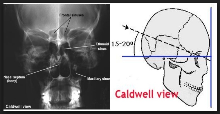 Caldwell view, PNS 엑스레이 : 네이버 블로그