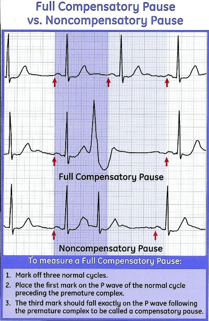 Atrial arrhythmia, Atrial premature contraction, 심방조기수축, Atrial ...
