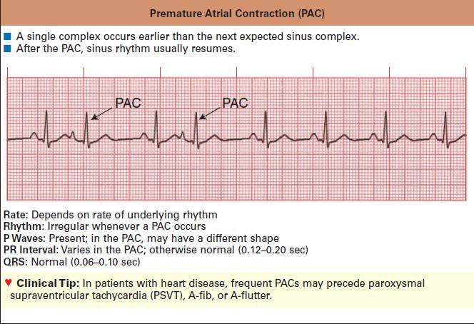 Atrial arrhythmia, Atrial premature contraction, 심방조기수축, Atrial ...