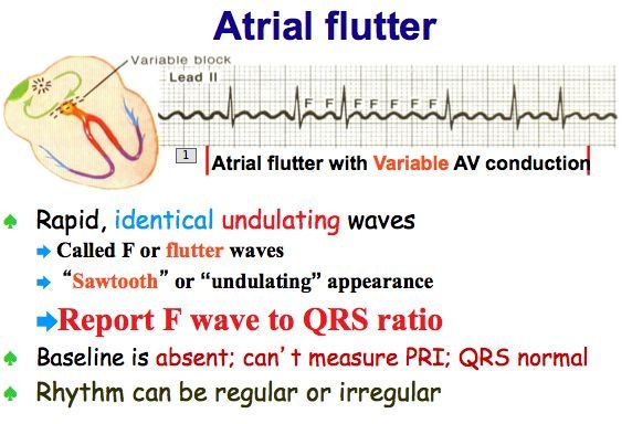 Atrial flutter (Af, AFL, 심방조동/된떨림) : 네이버 블로그