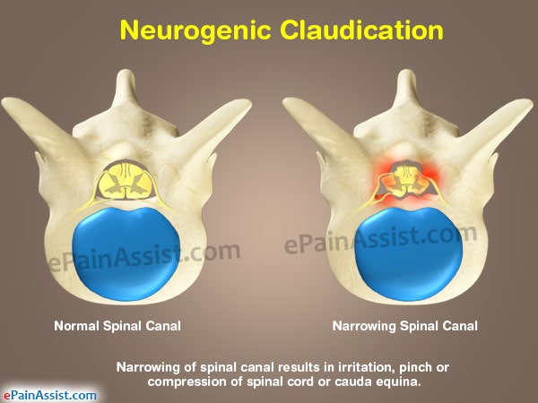 파행(Claudication)에 대하여.. : 네이버 블로그