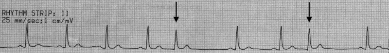 AV junctional arrhythmia, junctional premature complex, Junctional ...