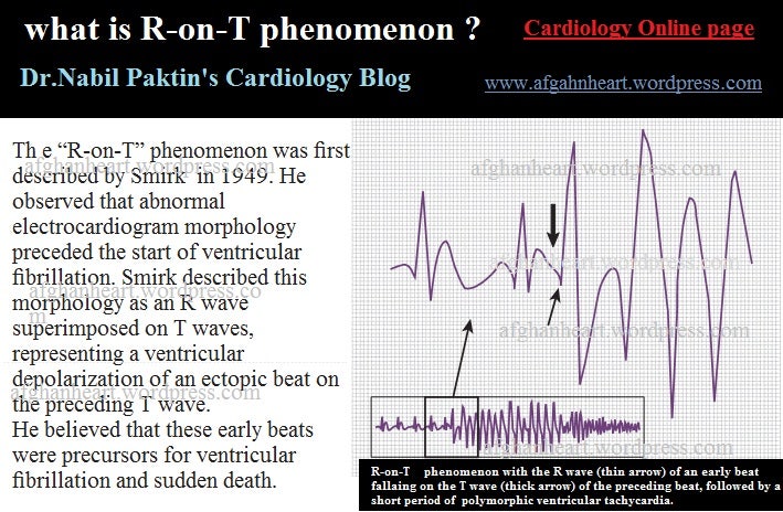 심실부정맥, Ventricular premature contraction/complex/beat (심실조기수축, VPC, VPB ...