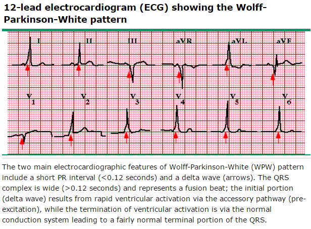 Wpw Syndrome Delta Wave