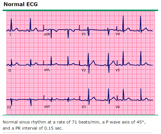 WPW 증후군, 심전도, Wolff-Parkinson-White syndrome, ECG : 네이버 블로그