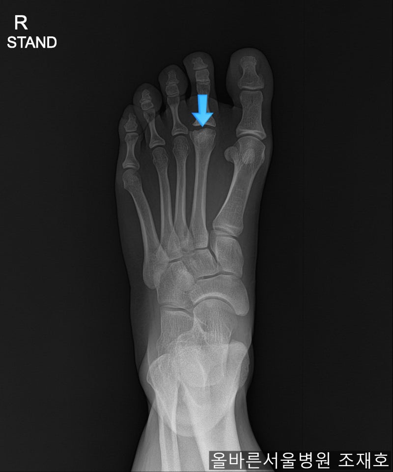 2족지의 프라이버그병(Freiberg disease)에서의 교정절골술(dorsal wedge osteotomy of 2nd ...