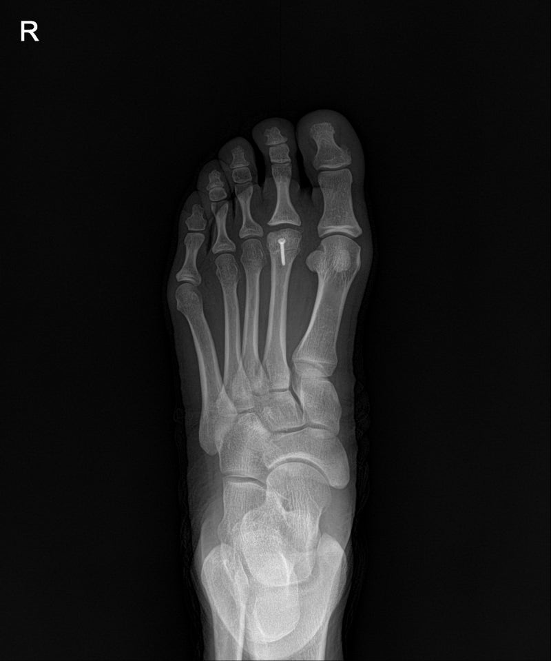 2족지의 프라이버그병(Freiberg disease)에서의 교정절골술(dorsal wedge osteotomy of 2nd ...