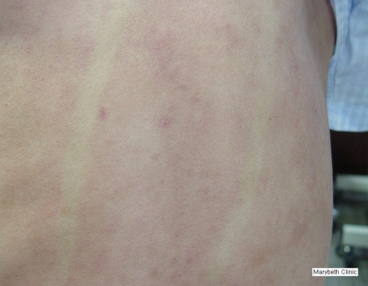 백색피부묘기증(백색피부그림증) White dermographism : 네이버 블로그