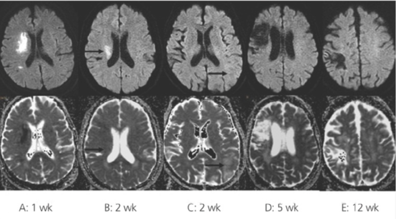 뇌혈관, 뇌졸중stroke시에 찍는 brain MRI 기초 : MRI 종류와 간단한 reading : 네이버 블로그