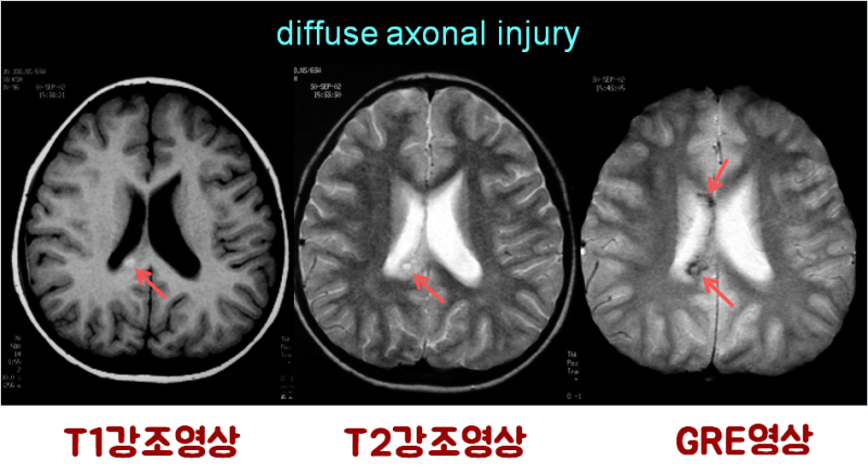 뇌혈관, 뇌졸중stroke시에 찍는 brain MRI 기초 : MRI 종류와 간단한 reading : 네이버 블로그