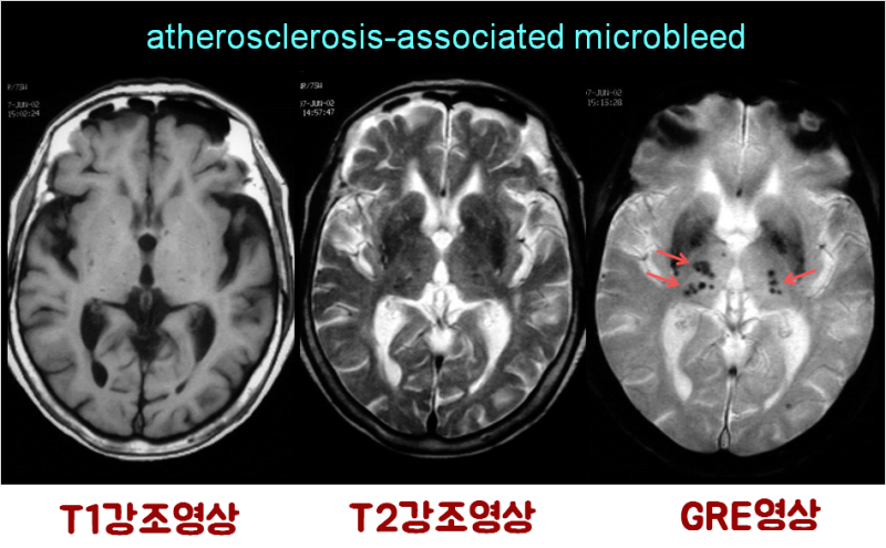 뇌혈관, 뇌졸중stroke시에 찍는 brain MRI 기초 : MRI 종류와 간단한 reading : 네이버 블로그