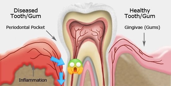 잇몸병 치주염과 치은염의 차이 치은염 치료방법과 자가진단가이드 서울윈치과 오이도 치과 네이버 블로그