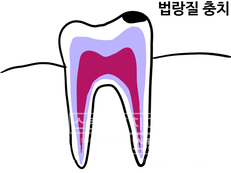 충치치료 종류 알아보기 신경치료 과정 및 통증 비용 네이버 블로그
