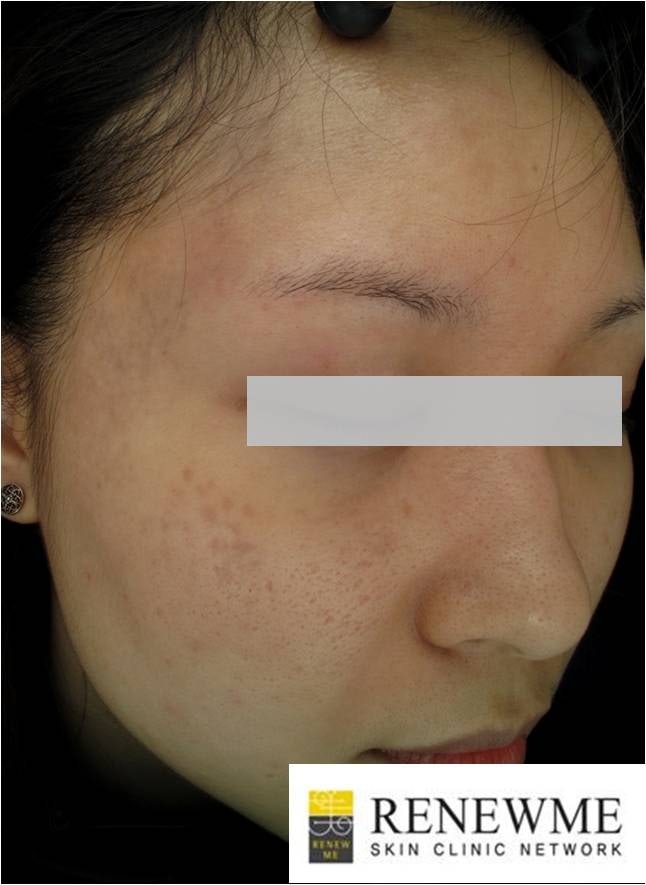 [분당 오타양모반] ABNOM, 양측성오타양모반 치료 사례, 리뉴미피부과 : 네이버 블로그