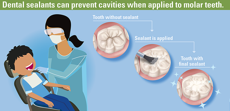 신내동 이삭치과 치아 홈메우기 실런트 Sealants 네이버 블로그