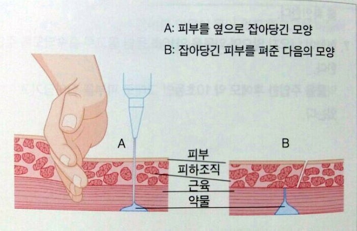 간호실습 Z Track을 이용한 근육주사법 네이버 블로그
