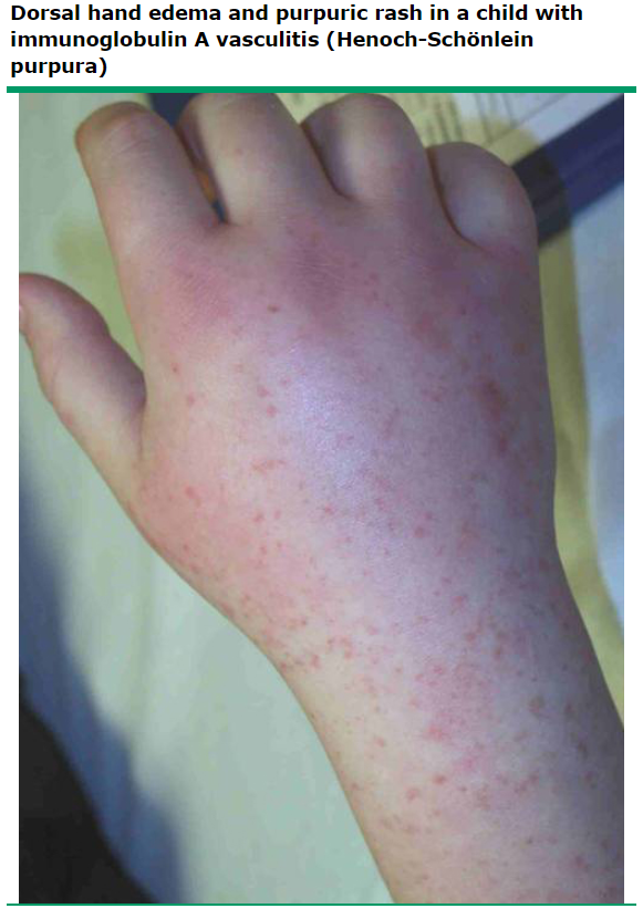IgA 혈관염, 발진, IgA vasculitis (Henoch-Schönlein purpura), rash : 네이버 블로그